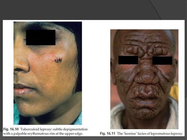 Leprosy - Dr. Julius King Kwedhi | PPT
