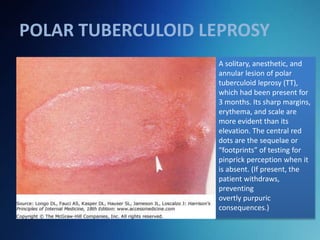 Leprosy - Dermatology | PPTX