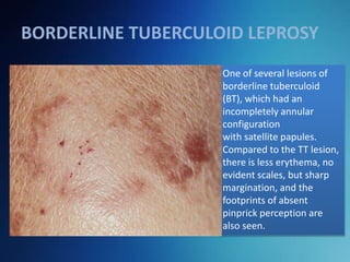 Leprosy - Dermatology | PPTX