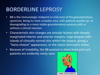 Leprosy - Dermatology | PPTX