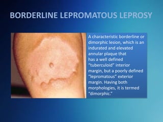 Leprosy - Dermatology | PPTX