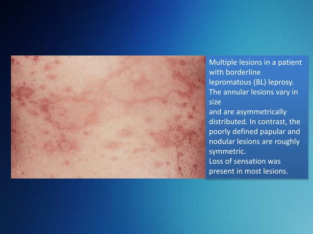 Leprosy - Dermatology | PPTX | Skin and Dermatology | Diseases and ...