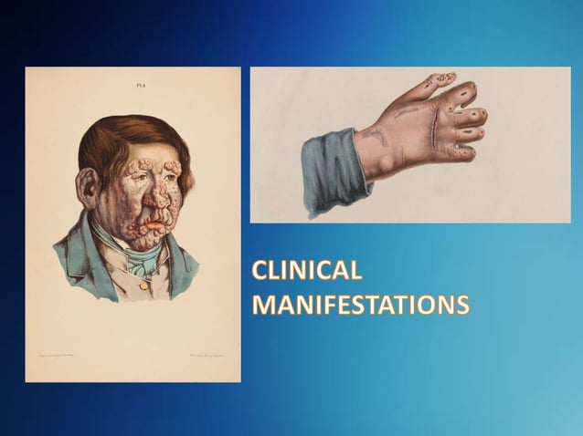 Leprosy - Dermatology | PPTX | Skin and Dermatology | Diseases and ...
