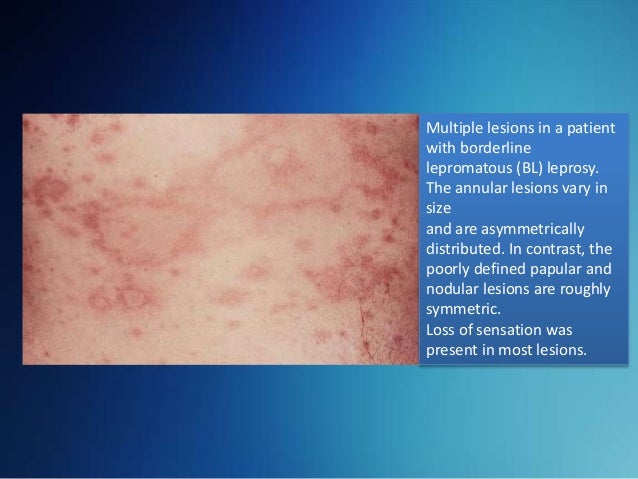 Leprosy - Dermatology