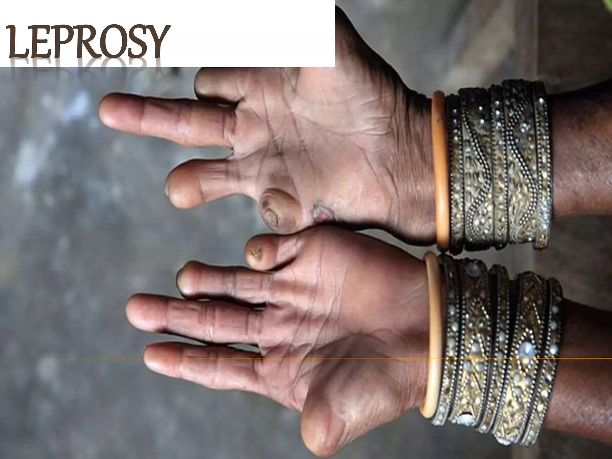 Leprosy | PPTX