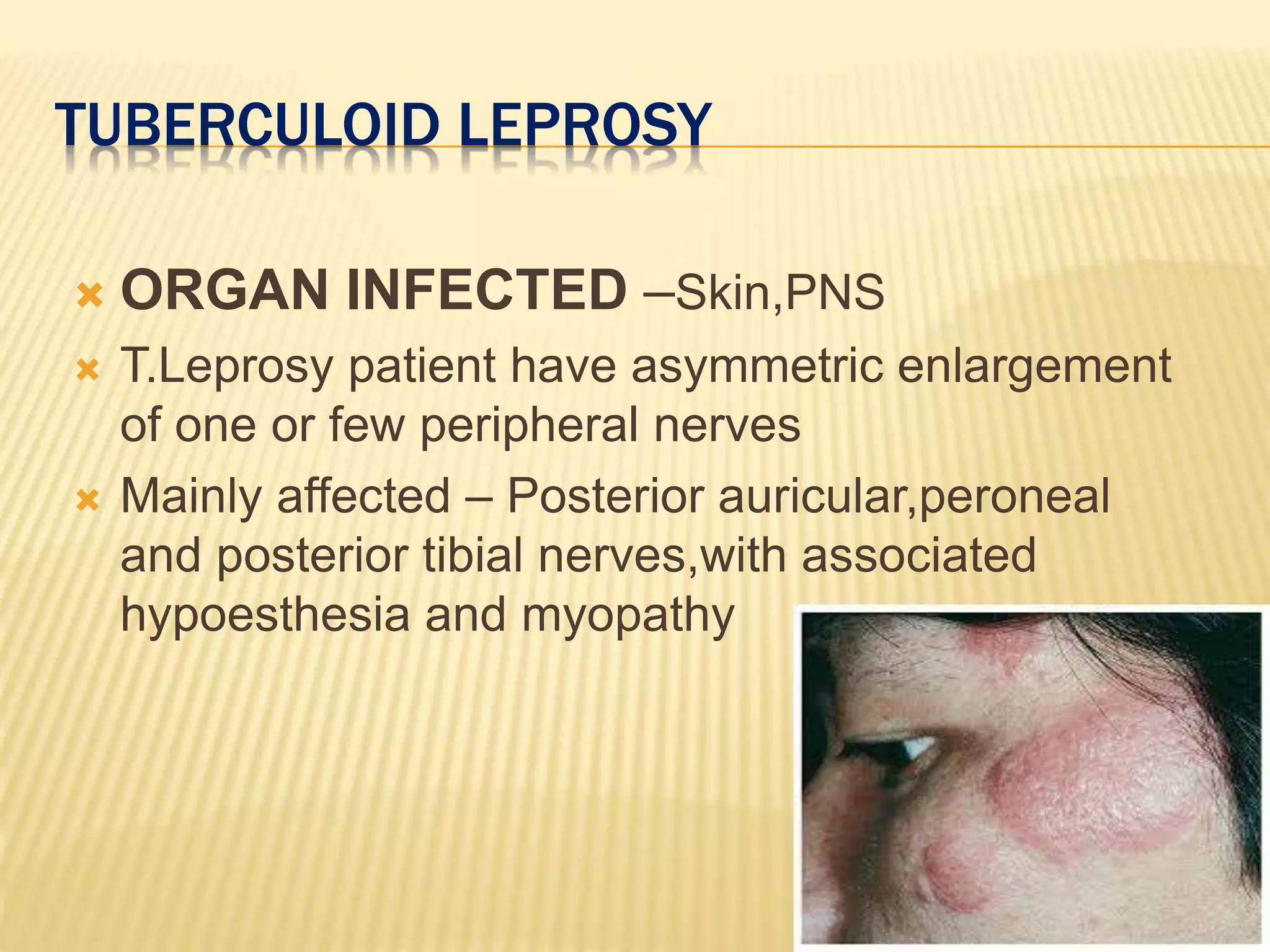 Leprosy | PPTX