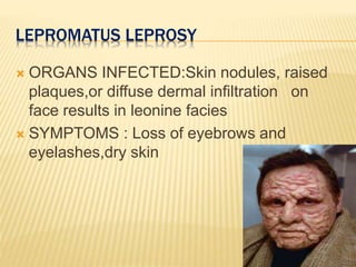 Leprosy | PPTX