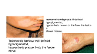Leprosy | PPTX