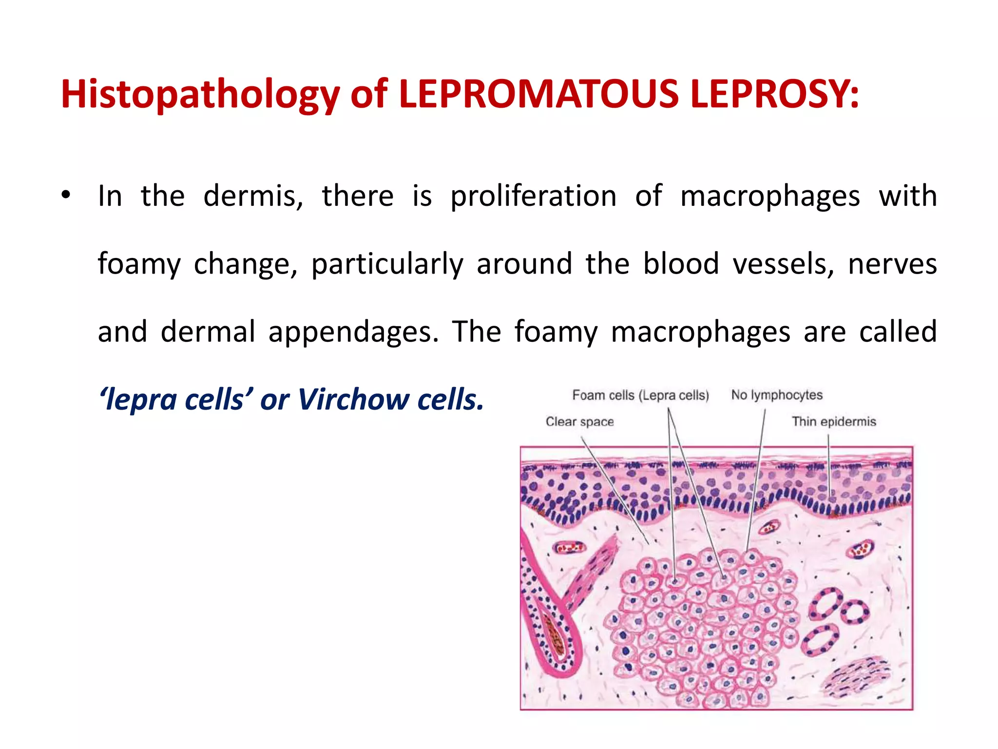 Leprosy | PPSX