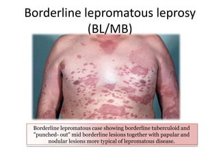 Leprosy 2 | PPT
