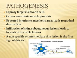 Leprosy | PPTX