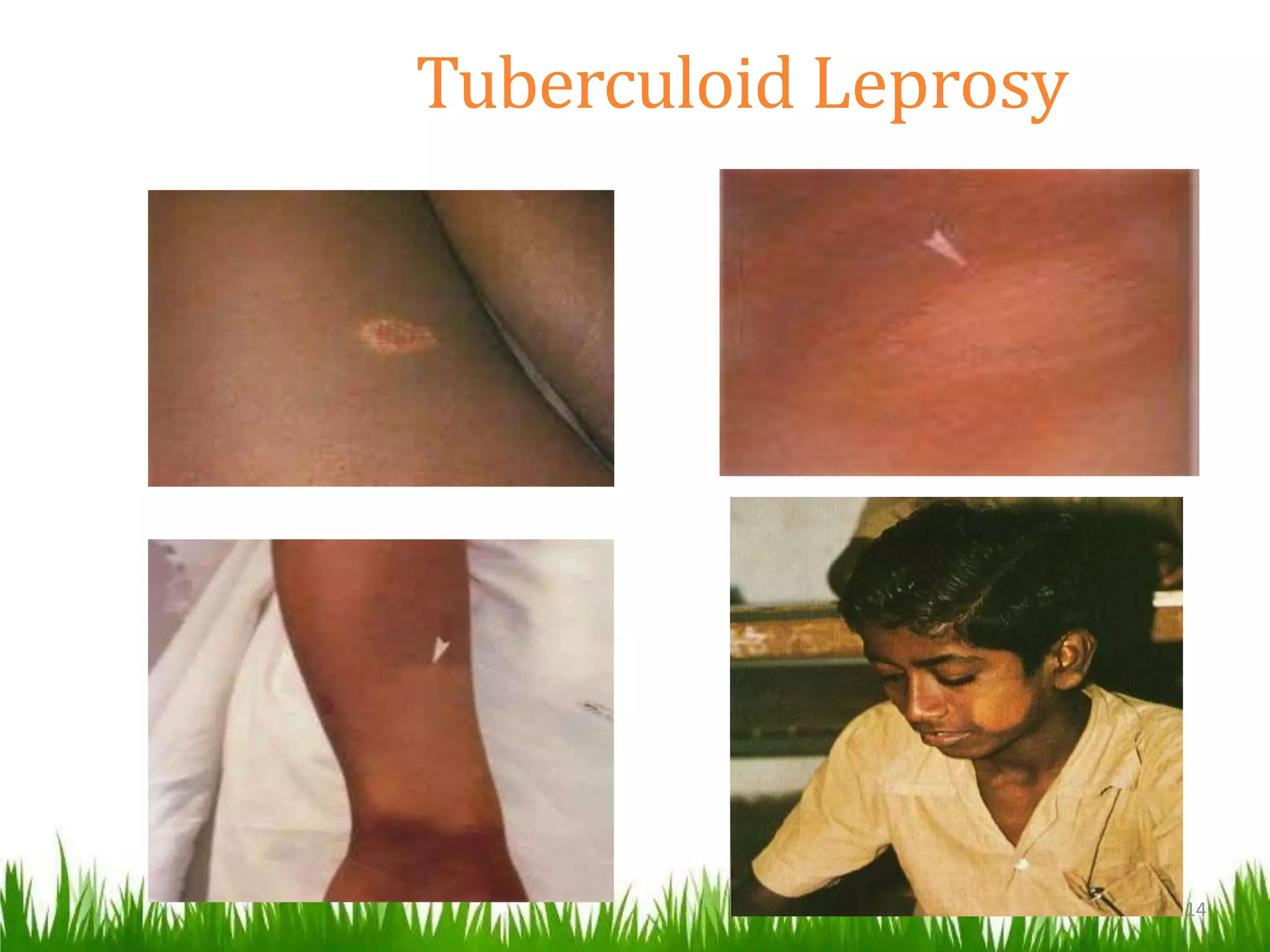Leprosy | PPTX