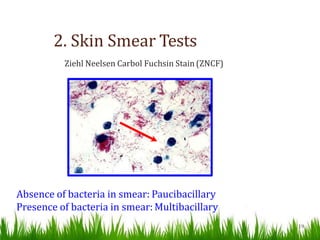 Leprosy | PPT