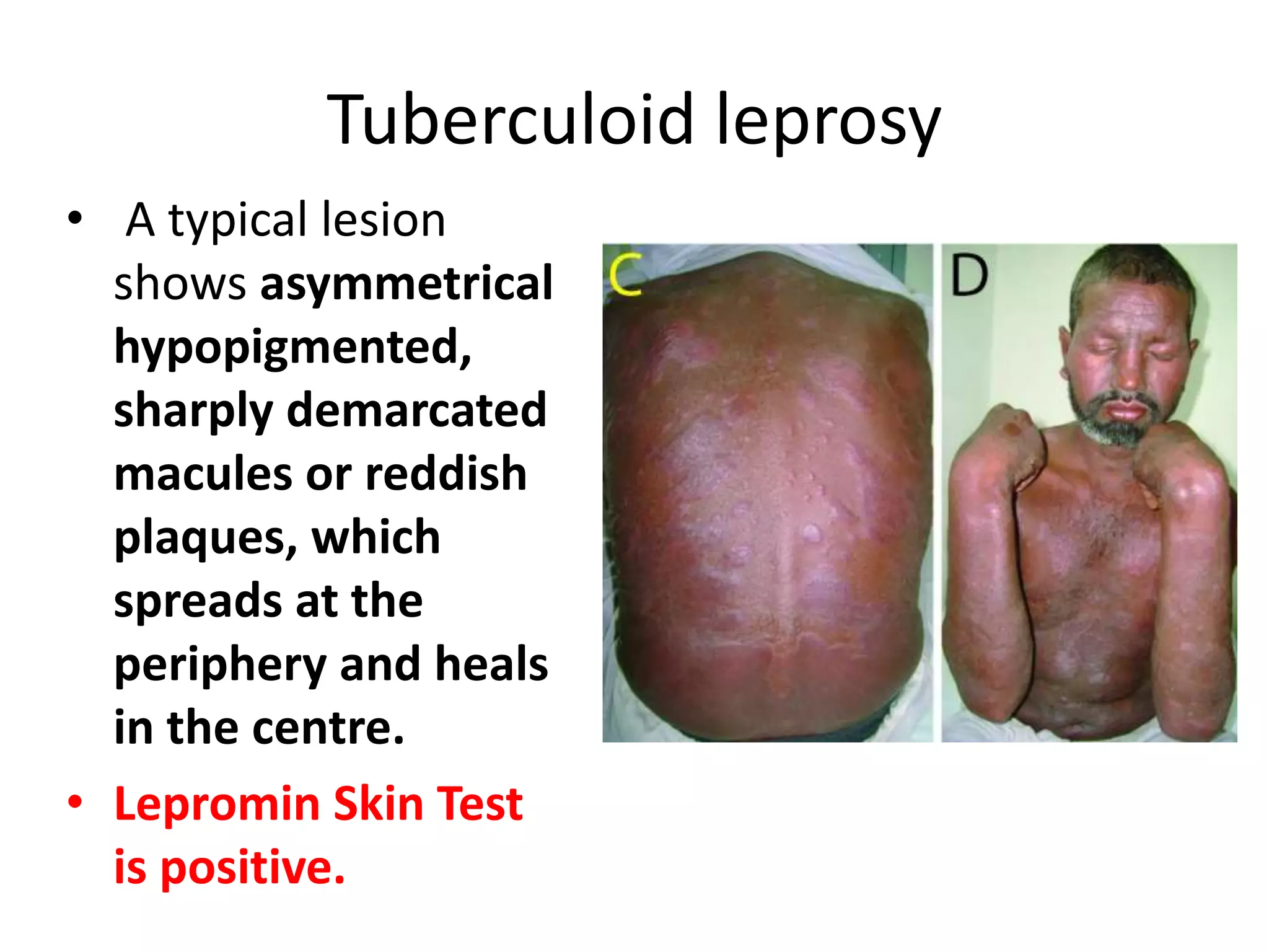 Leprosy . Dr. Abhinav Golla , Associate Professor , Lab Director ...