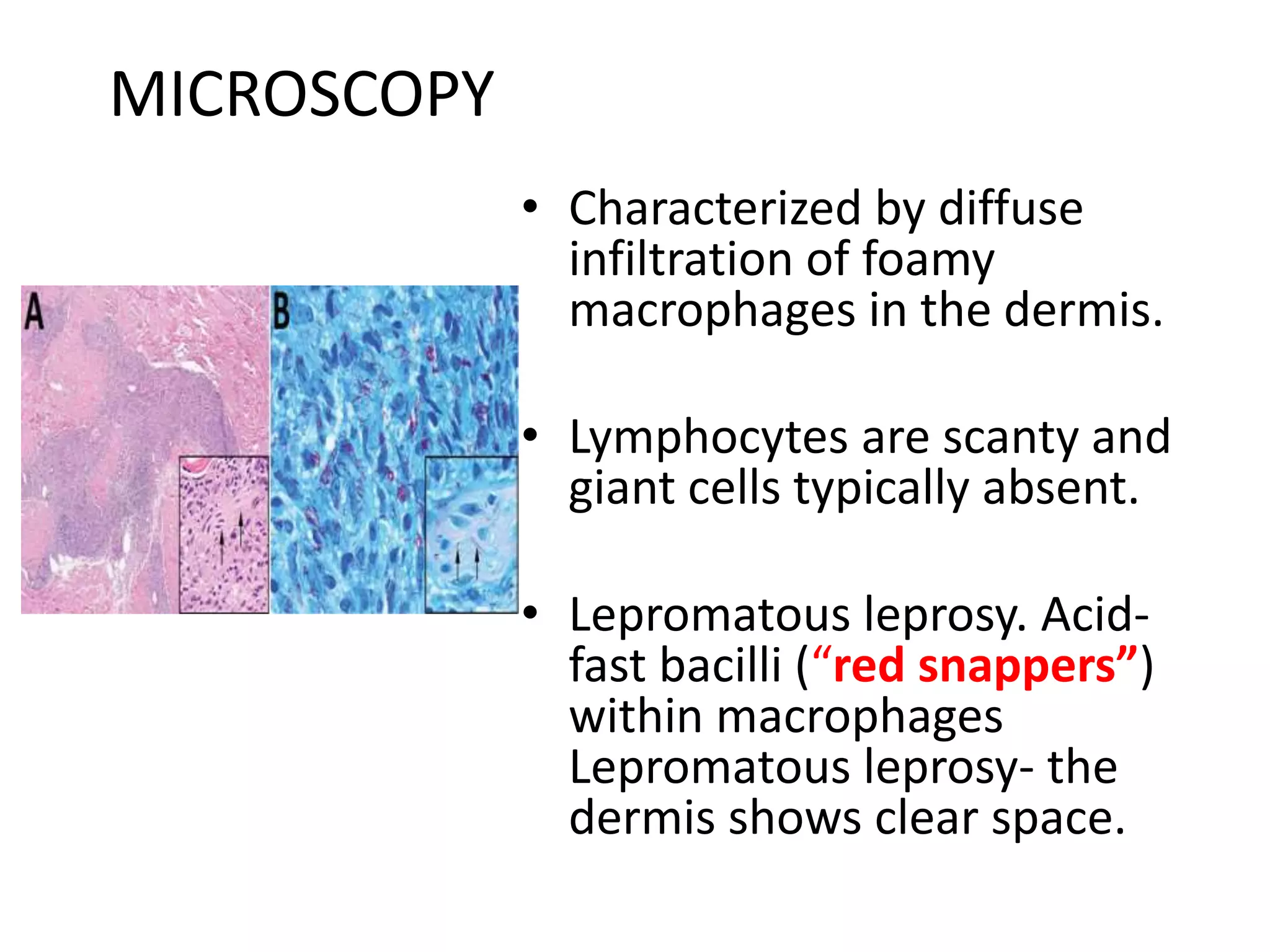 Leprosy . Dr. Abhinav Golla , Associate Professor , Lab Director ...