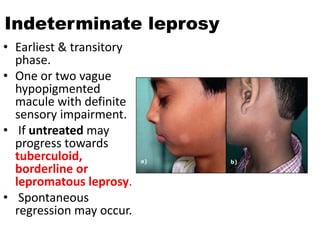 Leprosy | PPT
