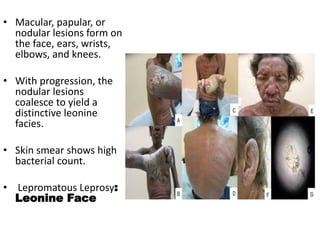 Leprosy | PPT