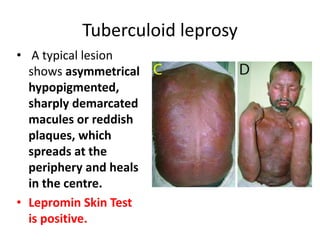 Leprosy . Dr. Abhinav Golla , Associate Professor , Lab Director ...