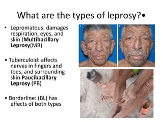 Leprosy Lion Face