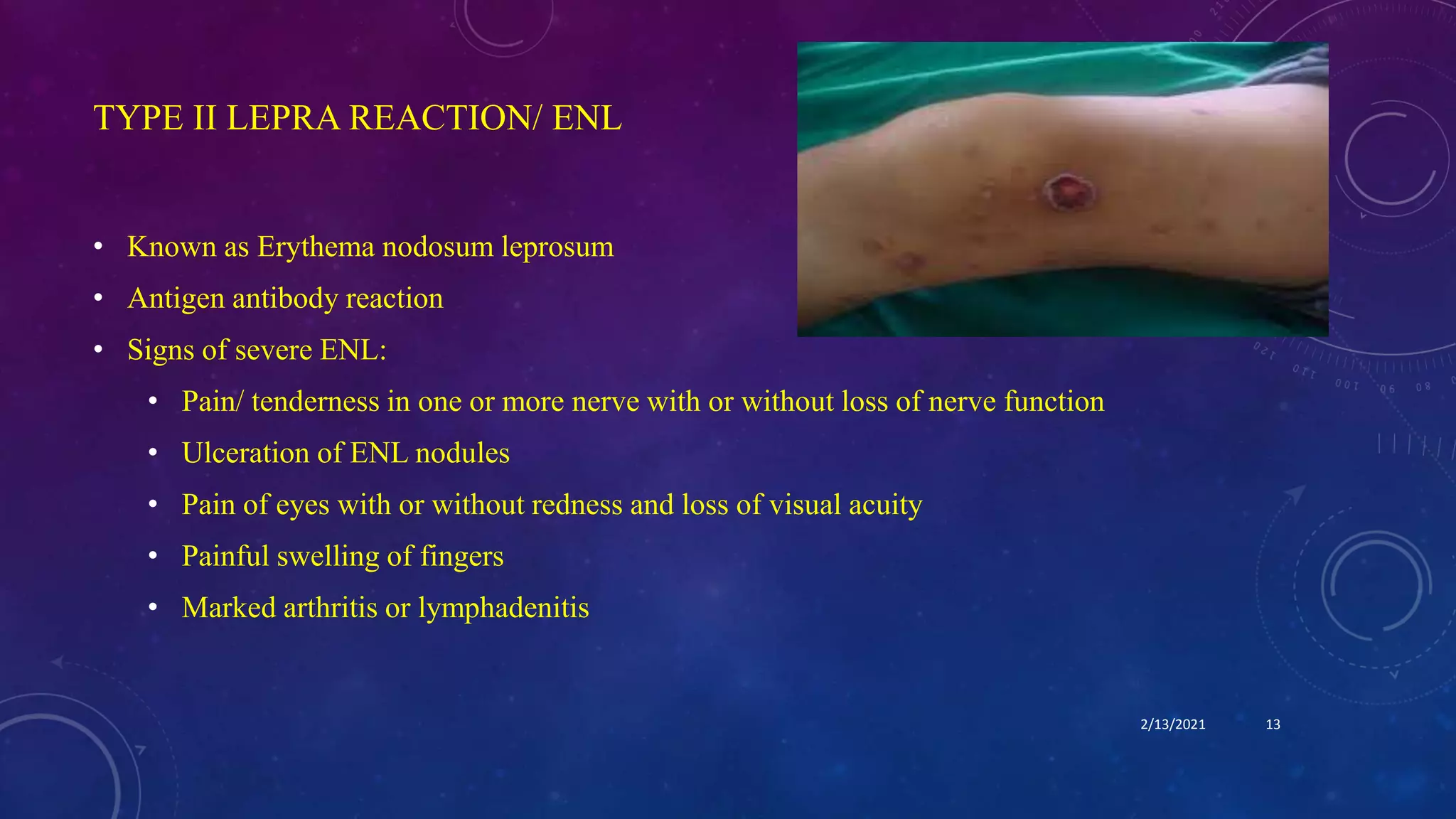 Leprosy | PPTX