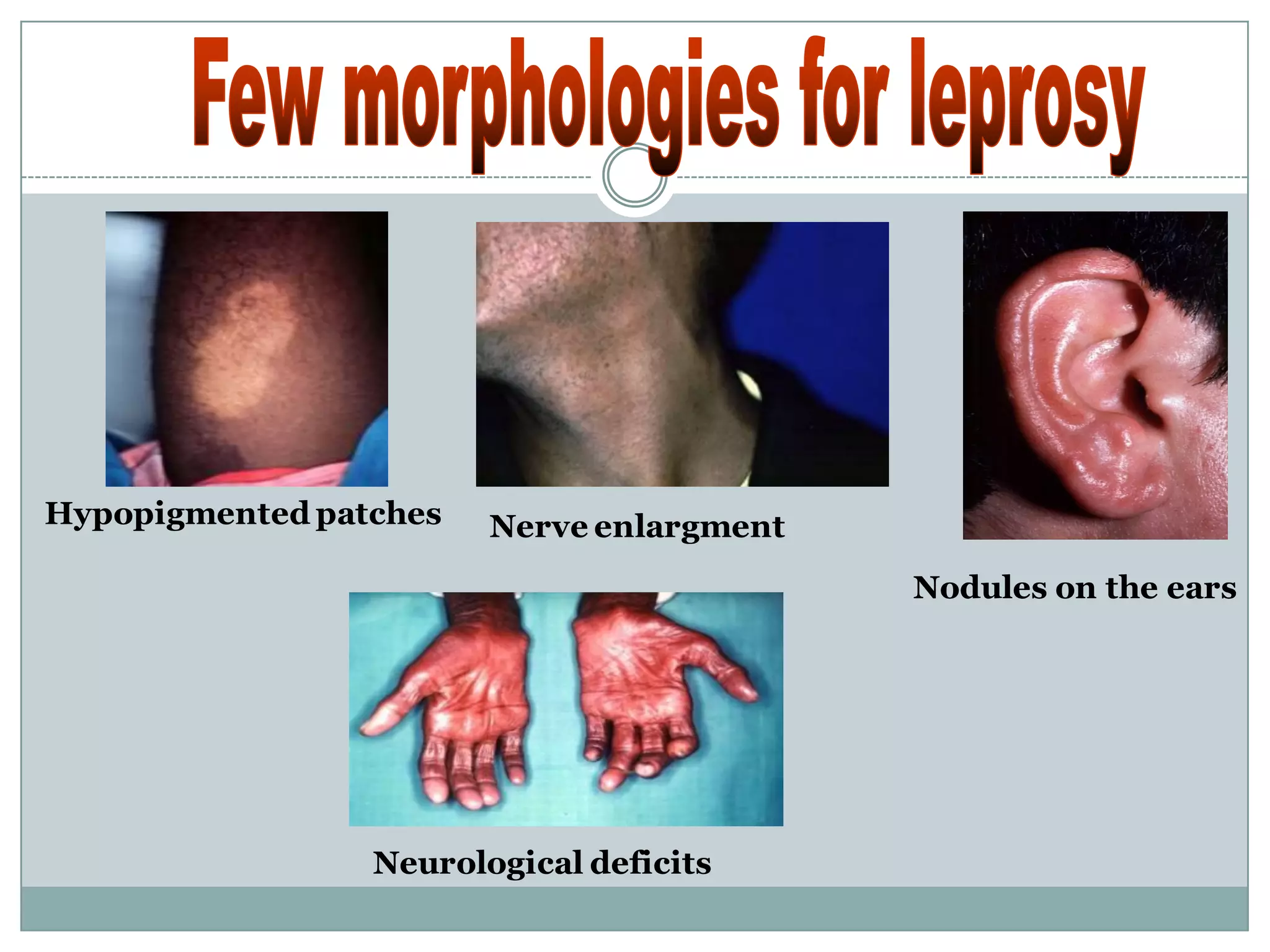 Leprosy | PPT