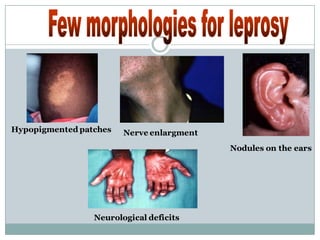 Leprosy | PDF