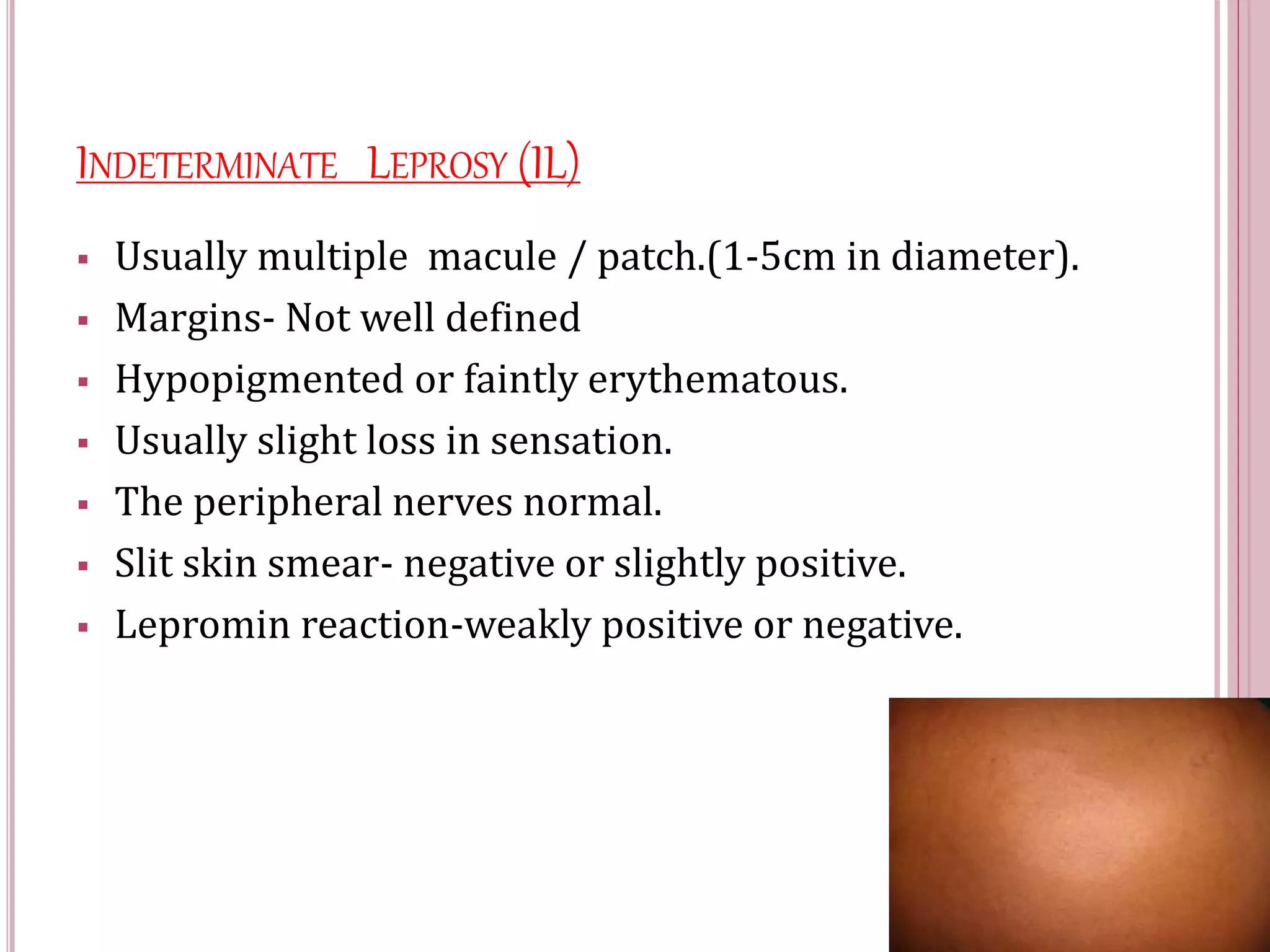 Diagnosis of Leprosy | PPTX