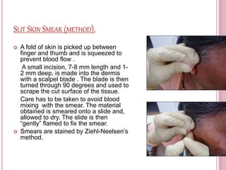 Diagnosis of Leprosy | PPTX