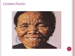 Diagnosis of Leprosy | PPT