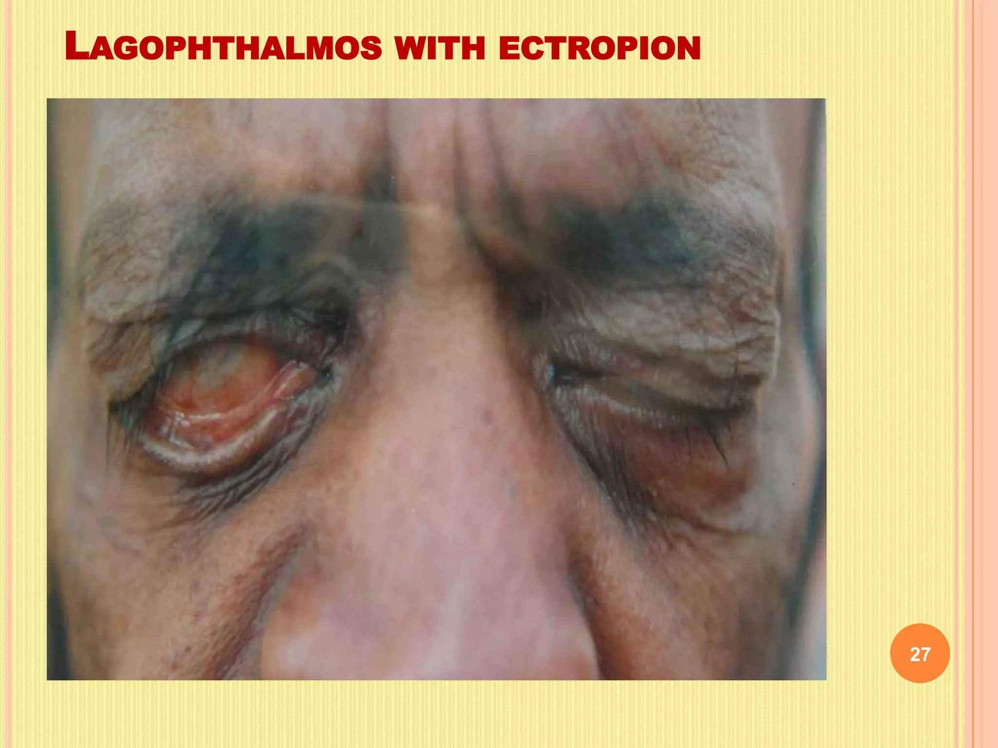 Leprosy.ppt