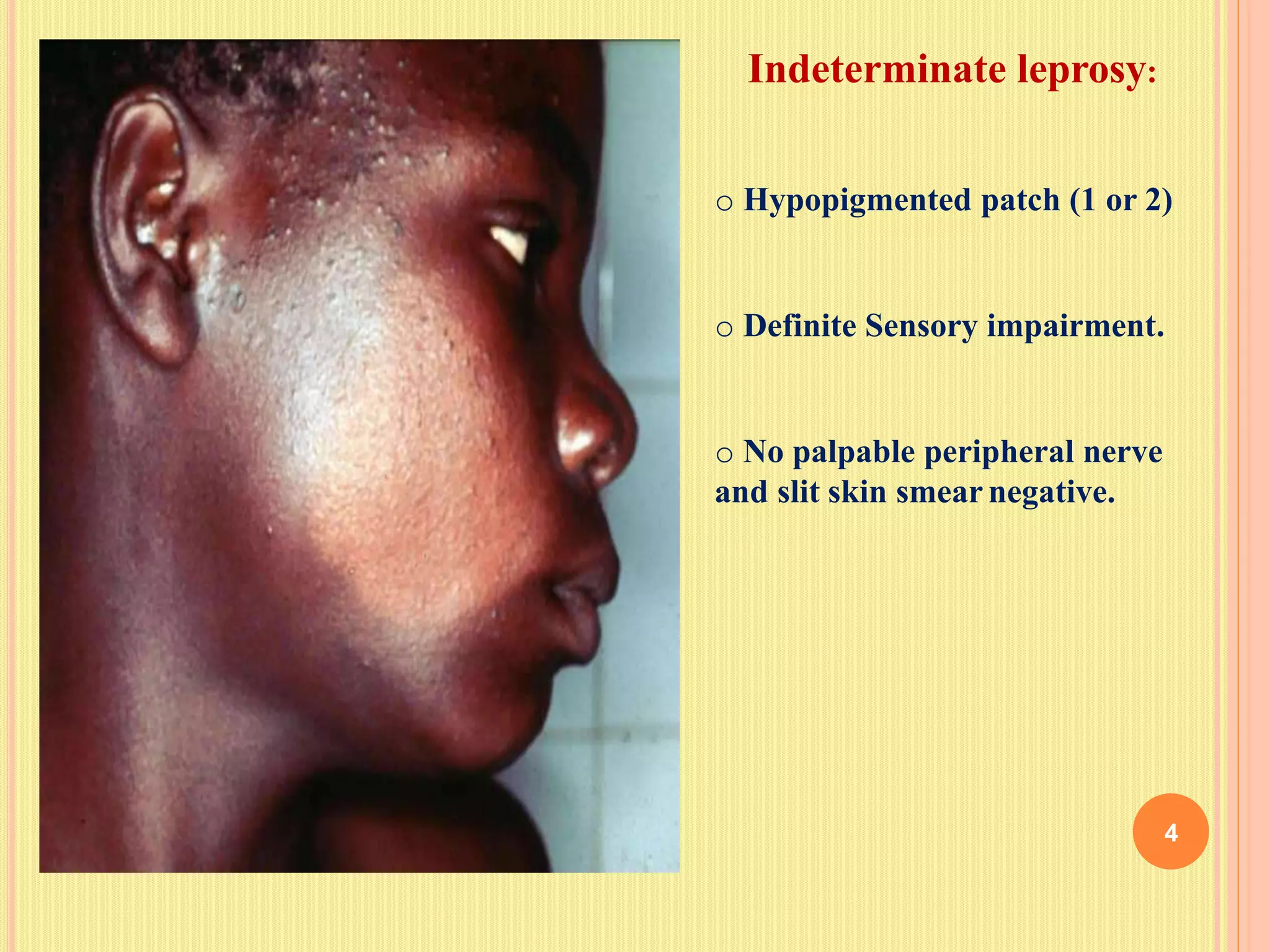Leprosy.ppt