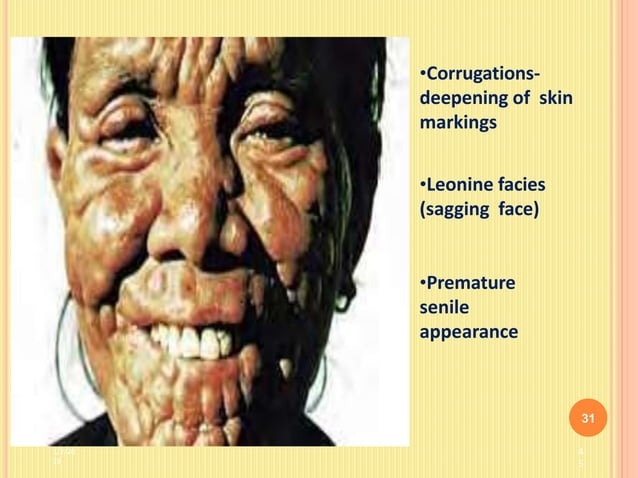 Leprosy.ppt | Infectious Diseases | Diseases and Conditions