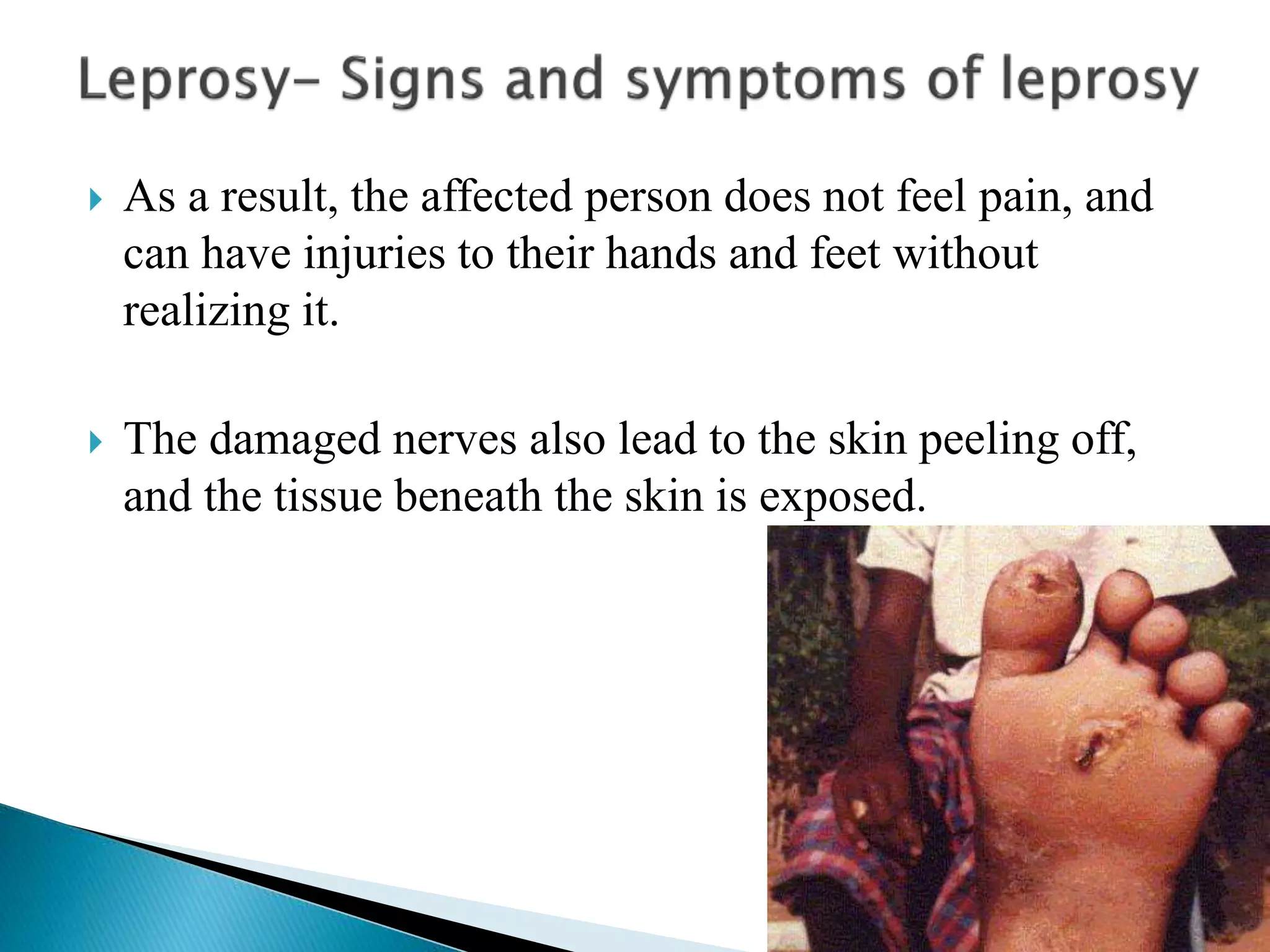 Leprosy.pptx