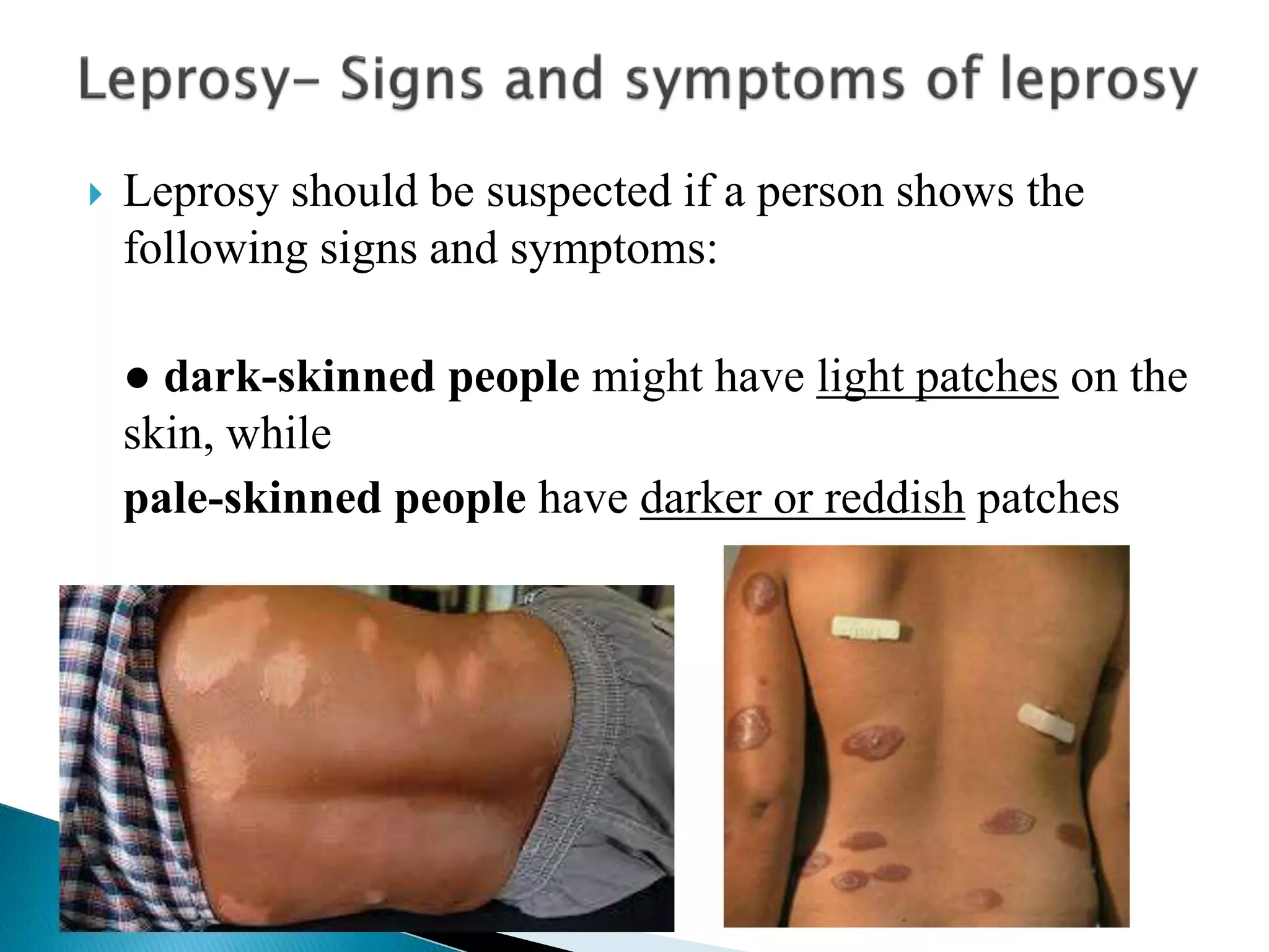 Leprosy.pptx