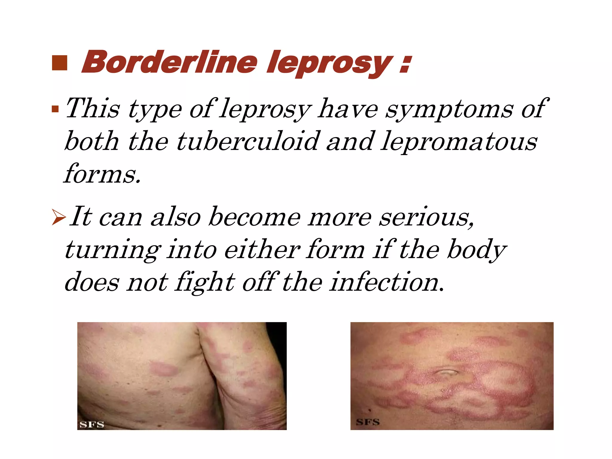 Leprosy_٢.pptx