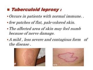 Leprosy_٢.pptx