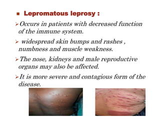 Leprosy_٢.pptx