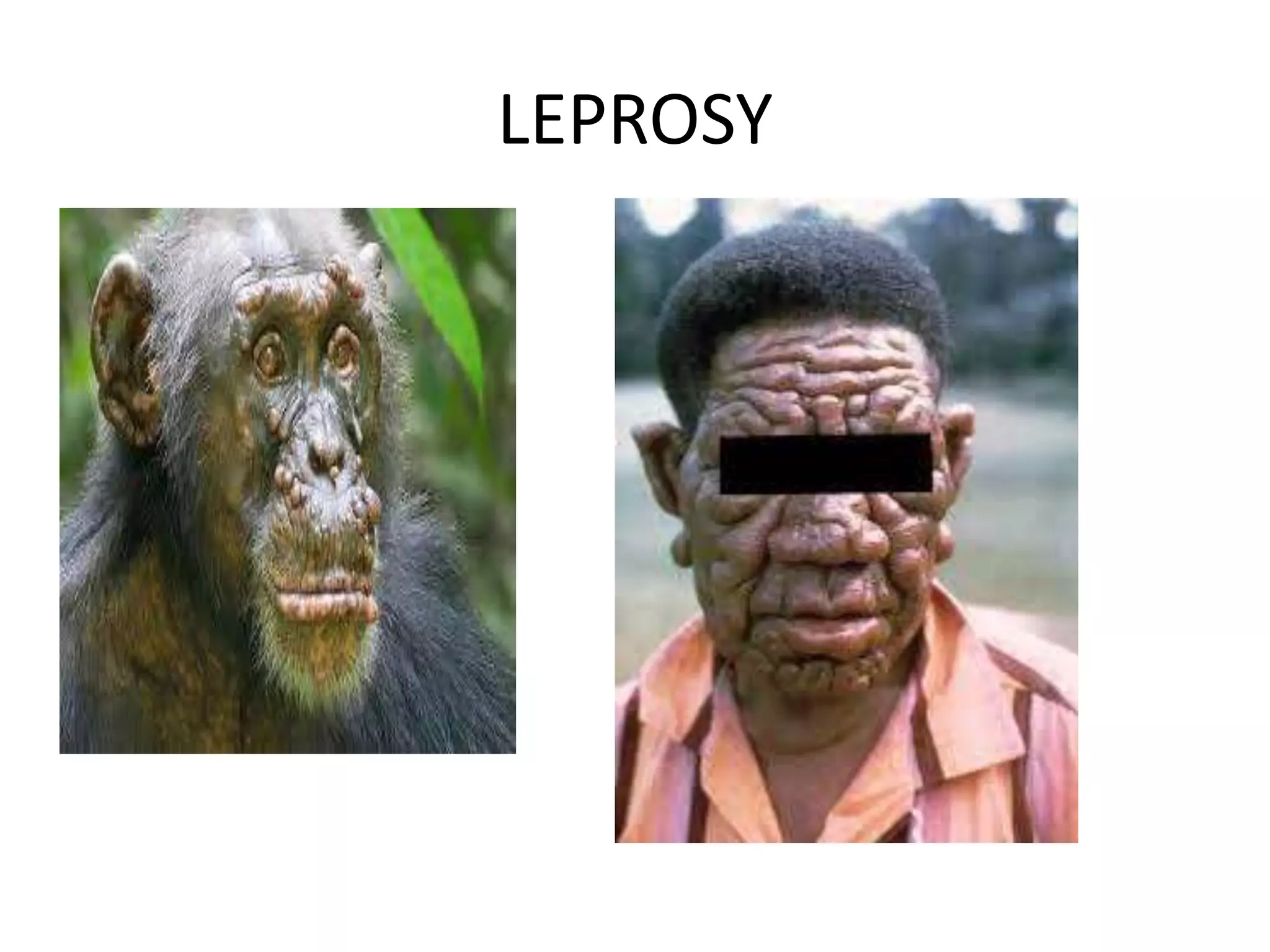 LEPROSY.pptx