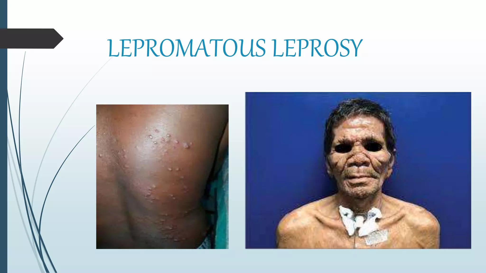 Leprosy.pptx