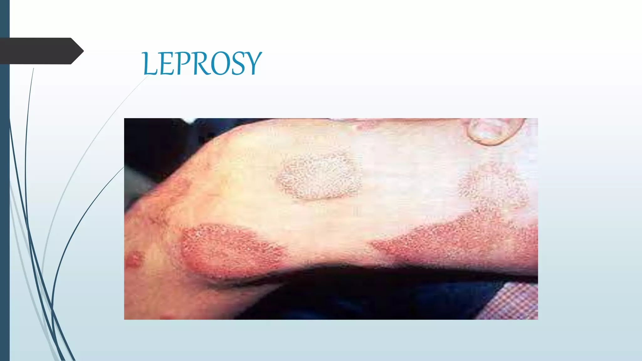 Leprosy.pptx