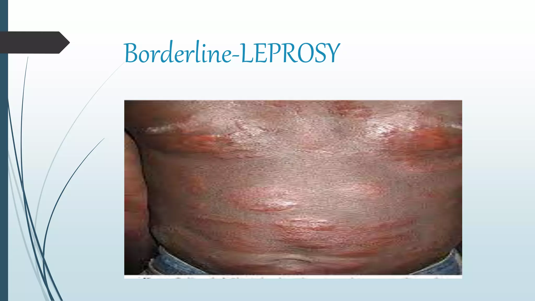 Leprosy.pptx
