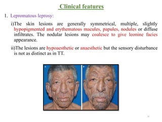 leprosy, pharmacologynotes, types,clinicalfeatures | PPTX