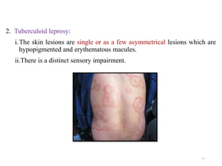leprosy, pharmacologynotes, types,clinicalfeatures | PPTX | Infectious ...
