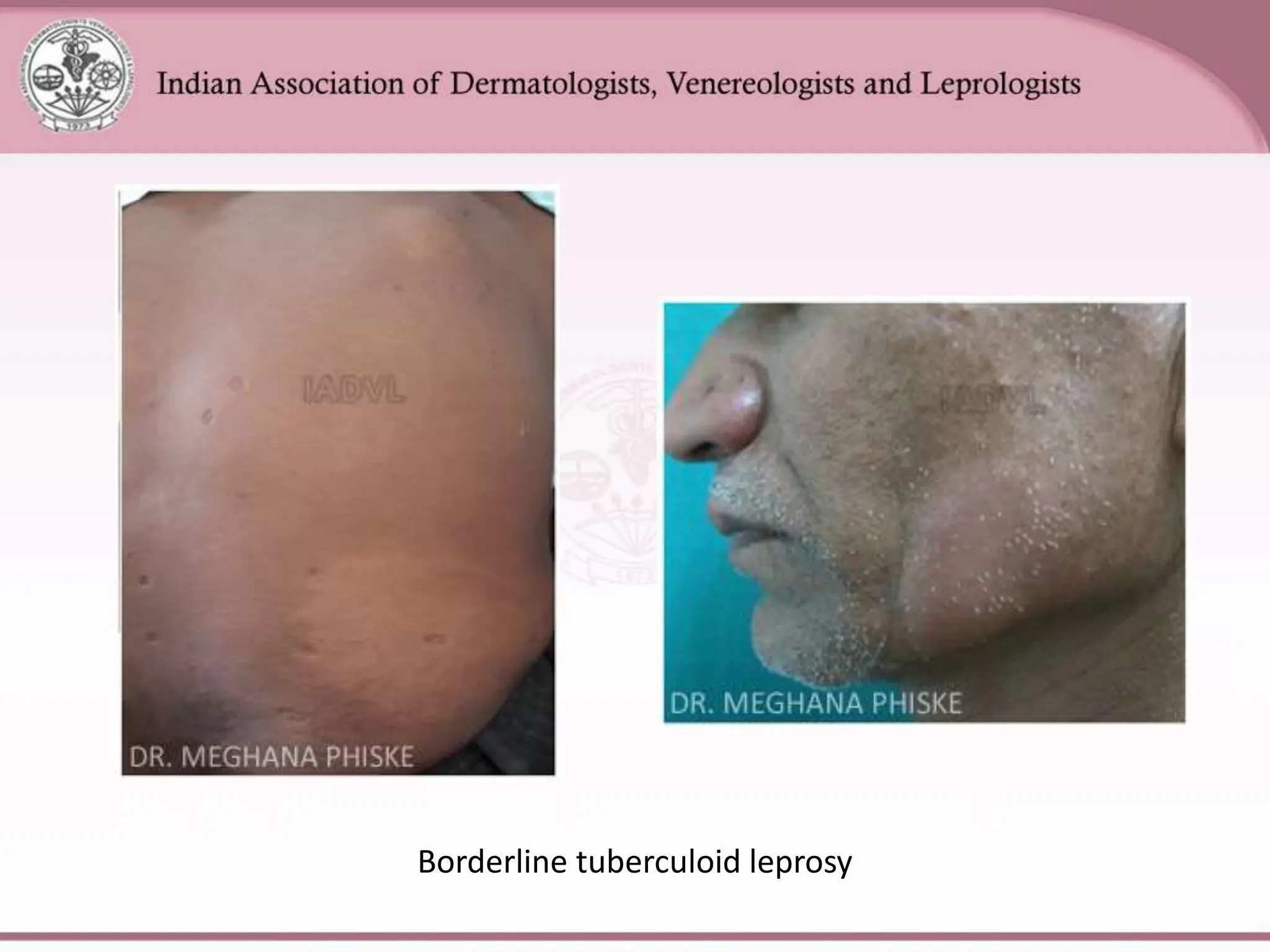 LEPROSY dermatology microbiology - hansen | PPTX