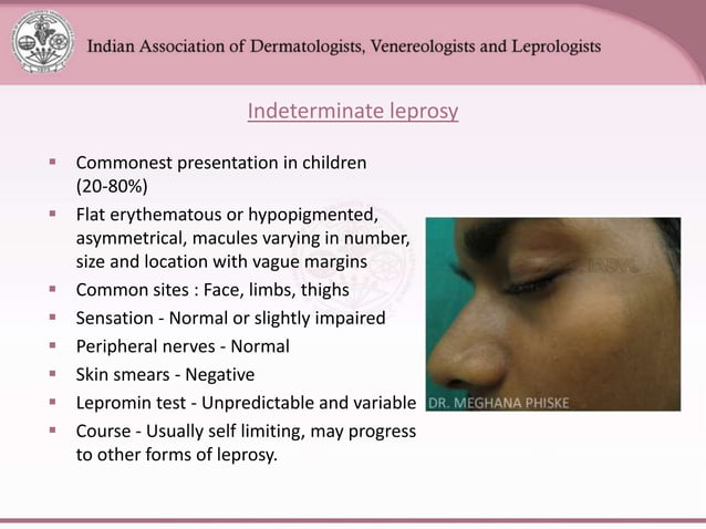 LEPROSY dermatology microbiology - hansen | PPTX