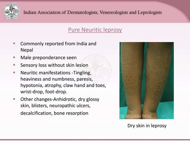 LEPROSY dermatology microbiology - hansen | PPTX