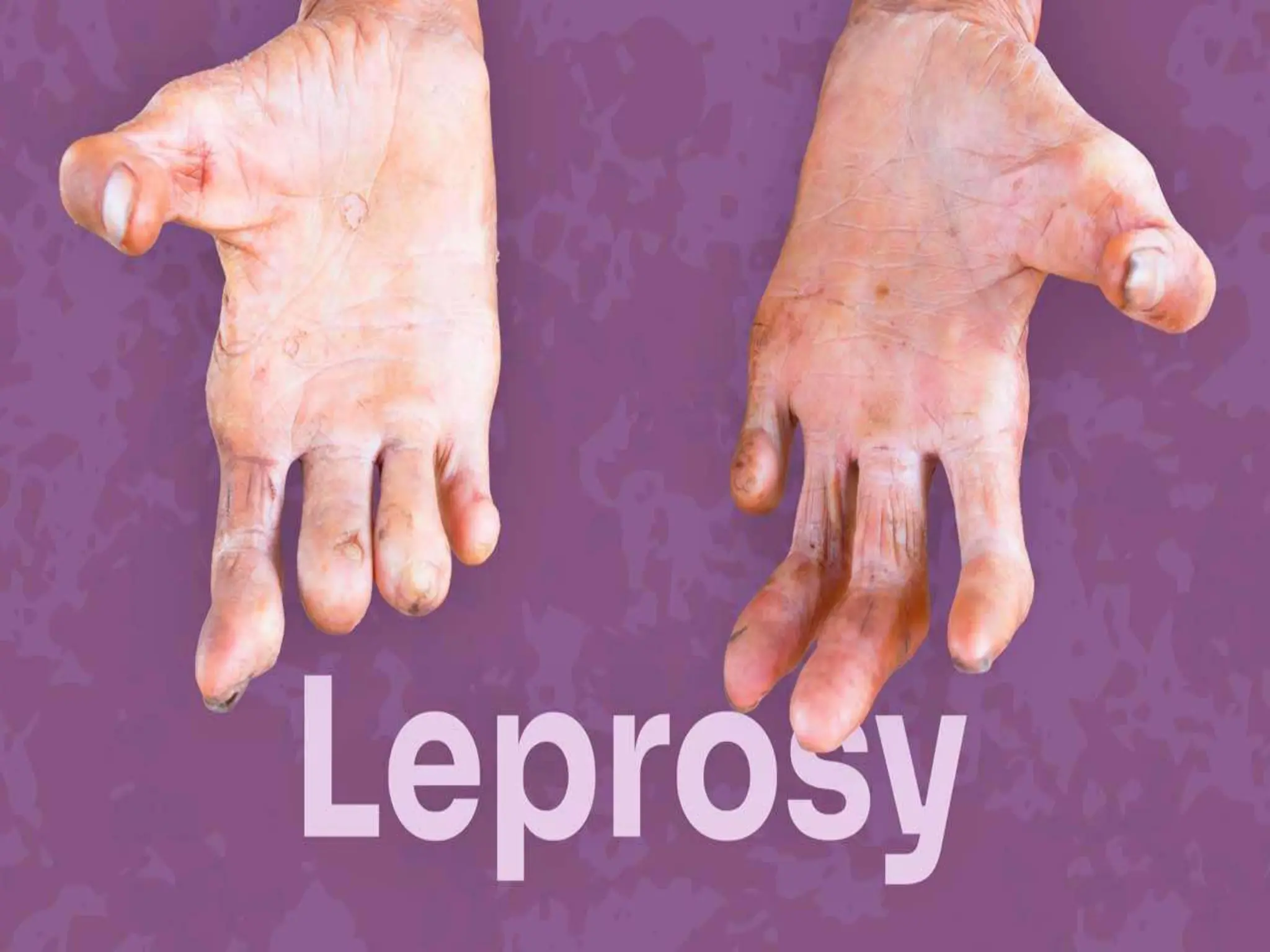 leprosy management of leprosy nursing students | PPTX