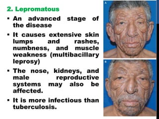 leprosy management of leprosy nursing students | PPTX