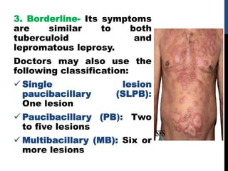 leprosy management of leprosy nursing students | PPTX