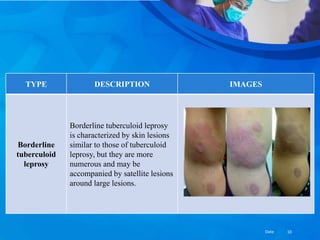 SKIN DISORDERS ADULT HEALTH NURSING-I LEPROSY.pptx